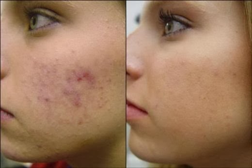 Pimple Inversa, Also Known As Hidradenitis Suppurativa, Info : 2013
