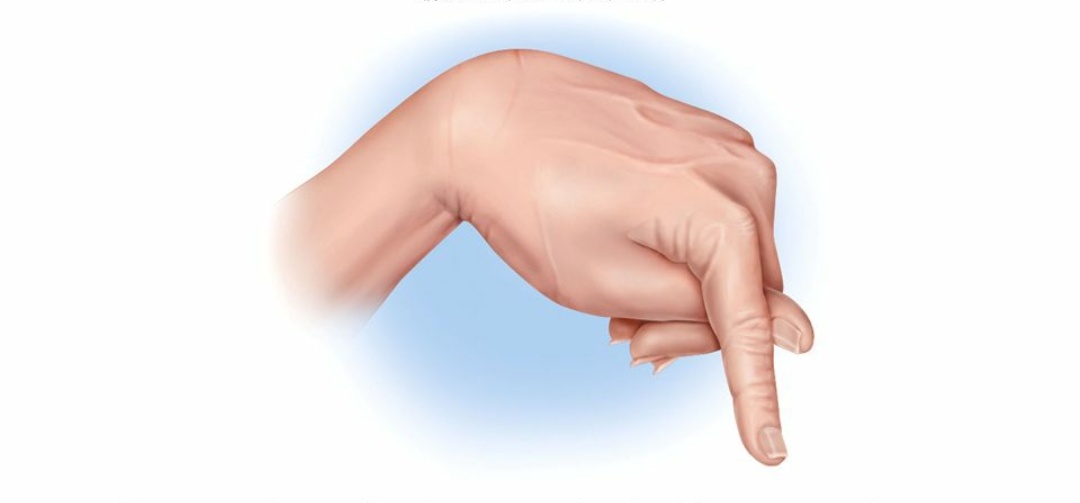 Tetanus | tetany | Hypoparathyroidism | Hypocalcemia | Disorder of ...