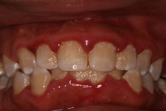 Domenick Coletti: Dental Plaque: A Daily Problem with Painful Consequences