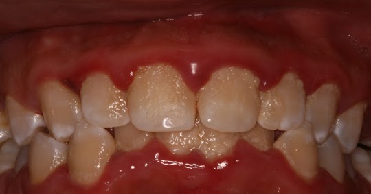 Domenick Coletti: Dental Plaque: A Daily Problem with Painful Consequences