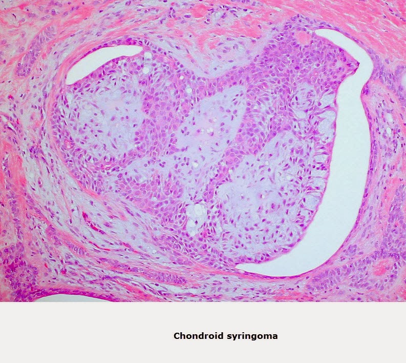 Dermpath Made Simple - Neoplastic: Syringoma