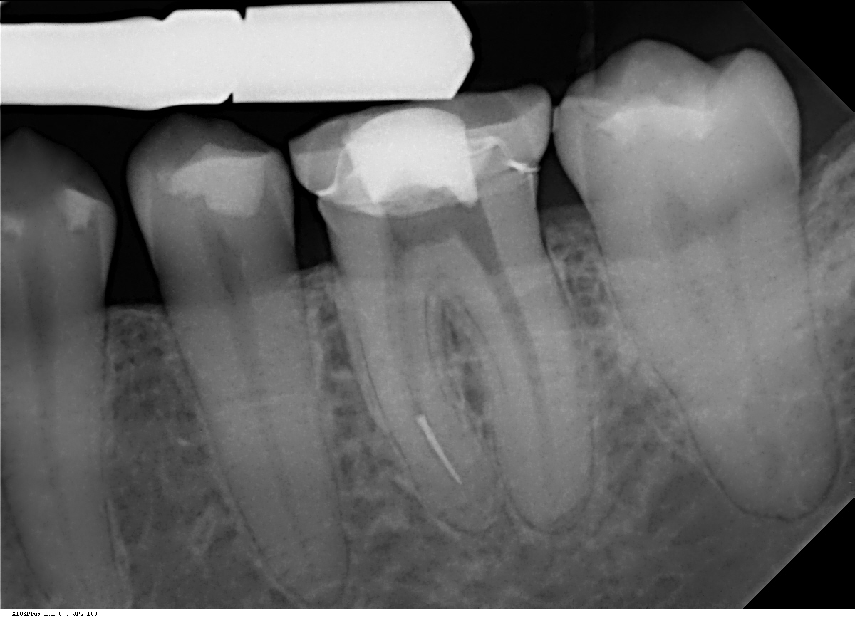 Complications Of Broken File In Root Canal At Dean Metoyer Blog