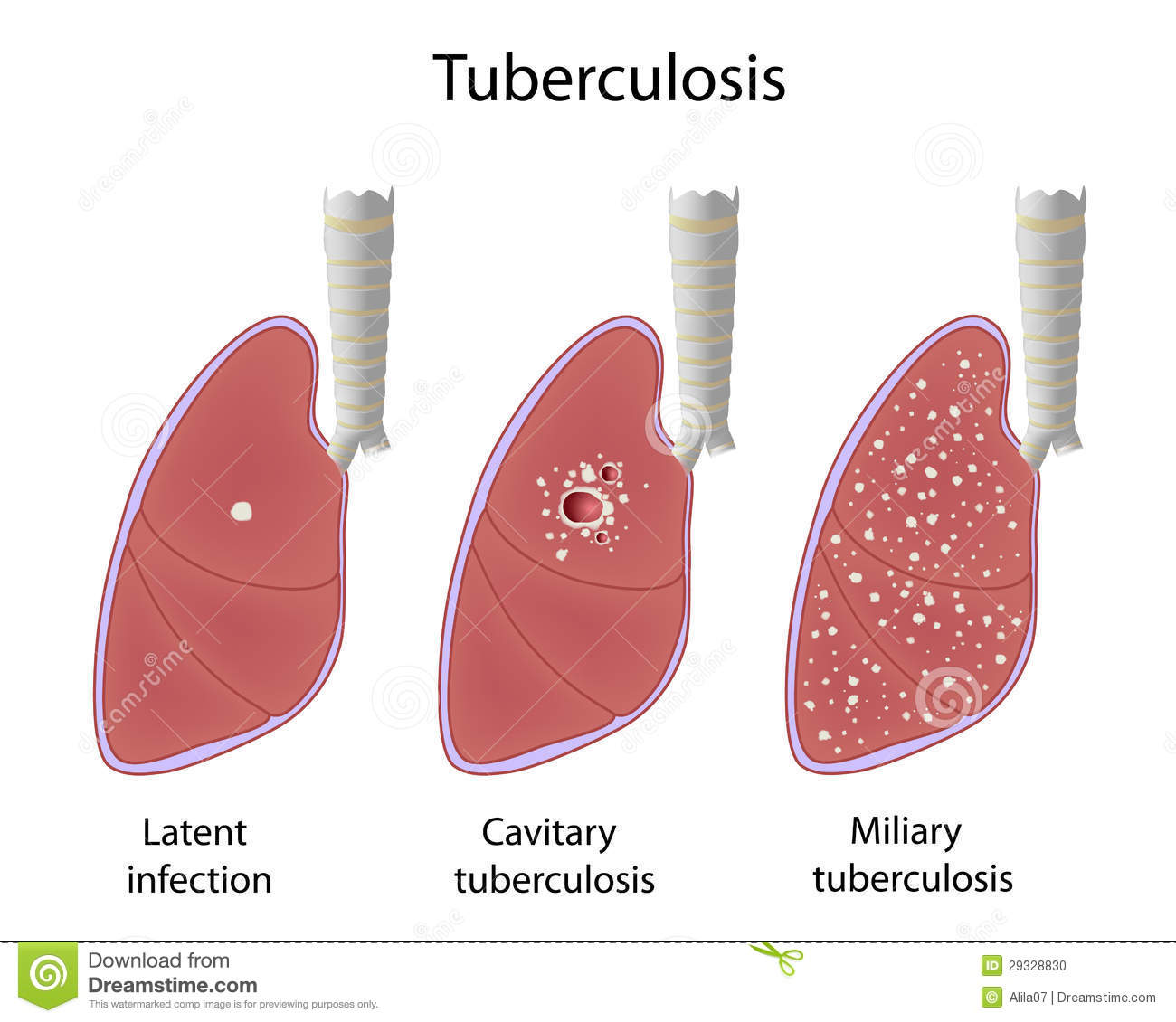 BIOLOGIA-ENFERMEDADES: TUBERCULOSIS PULMONAR