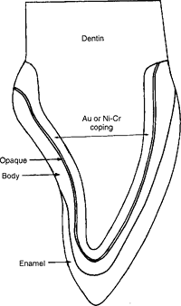 Metal Ceramic Crown Layers