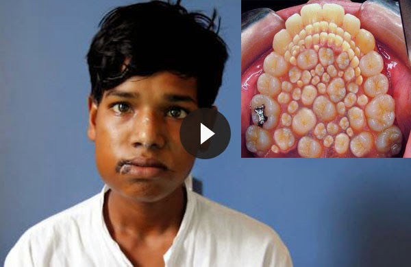 WATCH: 232 Teeth From Indian boy's mouth - MadPandaNews