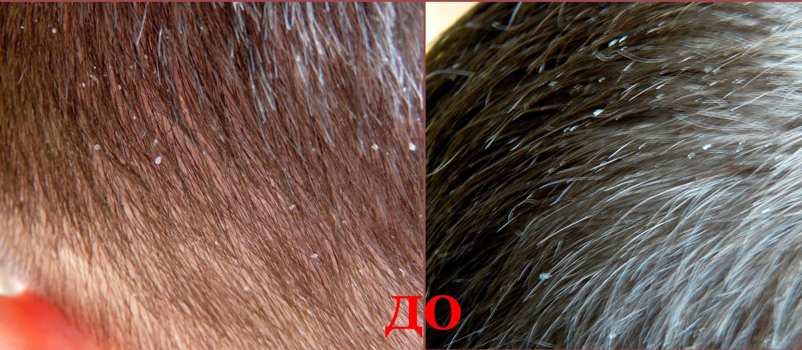 Life is wonderful: Шампунь от перхоти Alphakeptol DS от Item - отзыв ...