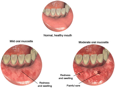 La mucositis, ¿qué es y cómo tratarla? | Nutrición a las 6