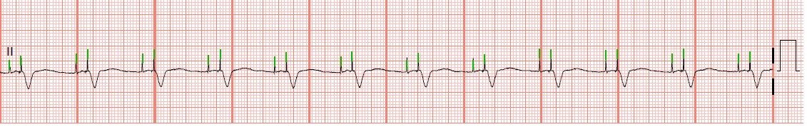 EKG Rhythm Strip Quiz 56: Paced Rhythms