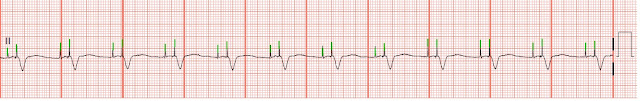 EKG Rhythm Strip Quiz 56: Paced Rhythms