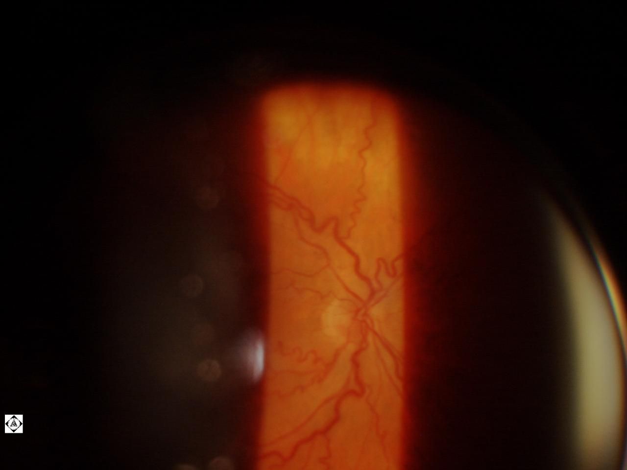 Sonoran Desert Eye Center: TORTUOUS RETINAL BLOOD VESSELS