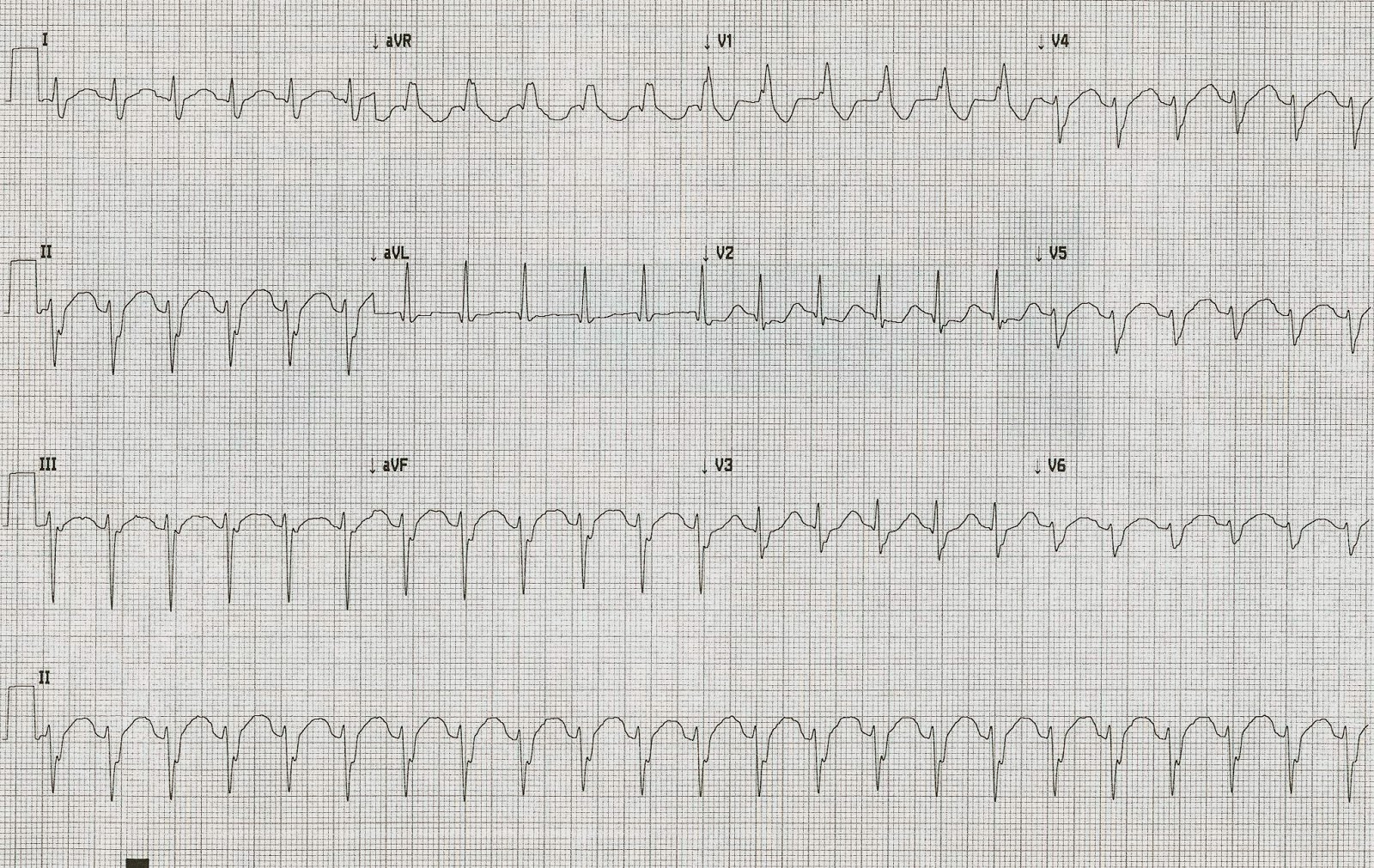 Dr. Smith's ECG Blog: Wide Complex Tachycardia. What is the Diagnosis?
