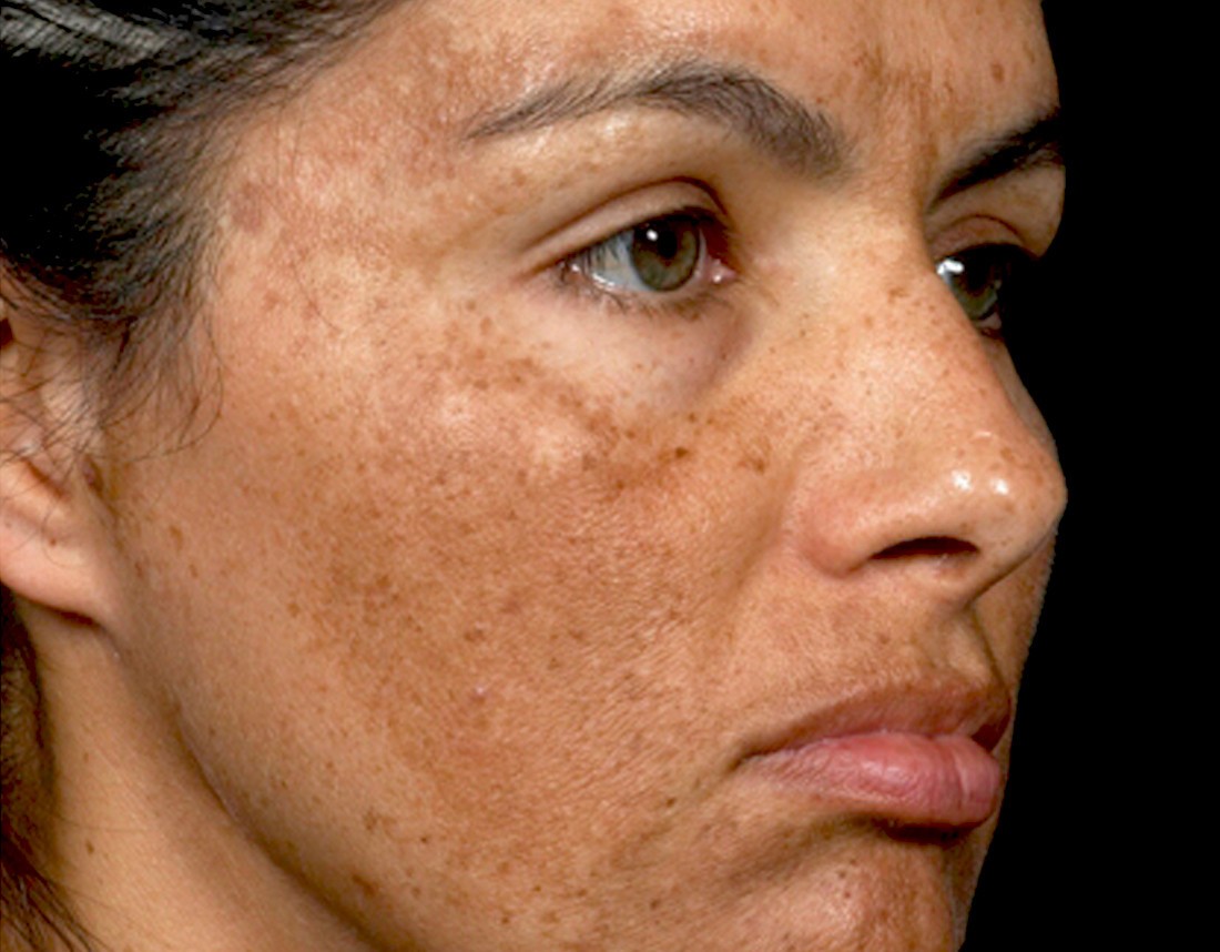Winning Skin Strategies Over Melasma Aka The Mask Of Pregnancy The winning-skin-strategies-over-melasma-aka-the-mask-of-pregnancy-the