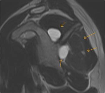 Spinoglenoid Ganglion Cyst with isolated Infraspinatus Atrophy - Sumer ...