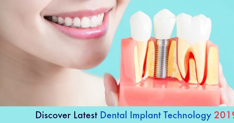 Discover Latest Dental Implant Technology 2019 - World Informs