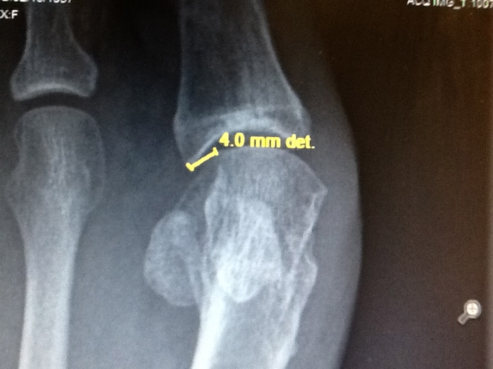 Foot and Ankle Problems By Dr. Richard Blake: Bunion Pain: Medially on ...