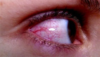 The Health World: The Causes of blood red eye