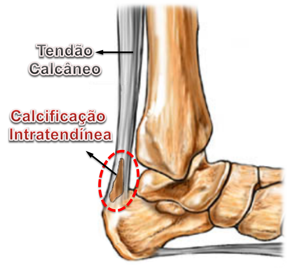 Entesófito Na Inserção Do Tendão Calcâneo - RETOEDU