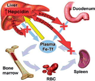 Iron Deficiency Anemia : Etiology/pathophysiology of disease