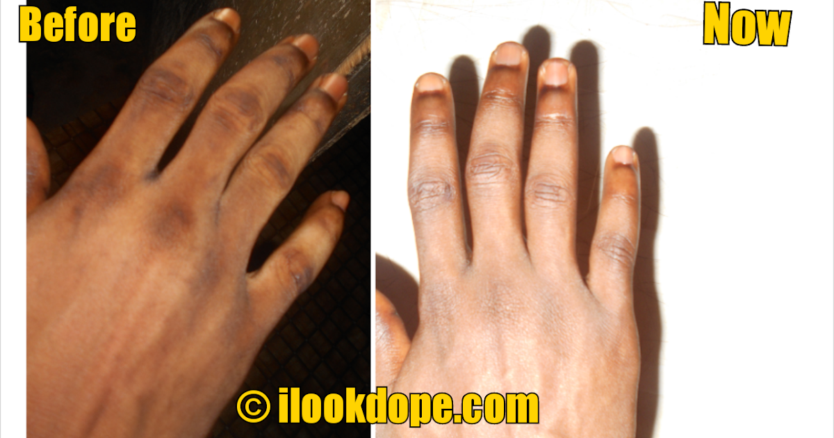 How I Lighten My Dark Knuckles & Joints At Home (With B&A ...