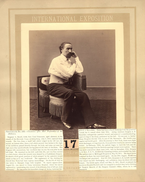 Eerie Vintage Portraits of Wounded Soldiers During the American Civil ...