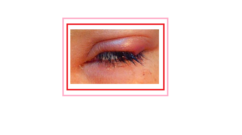 Develando la Salud: Los ojos y sus dolencias, Conjuntivitis, Orzuelo e ...