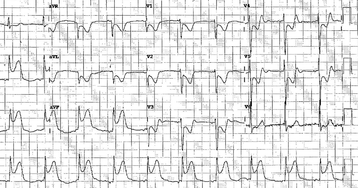 ECG of the Week: ECG of the Week - 10th July 2017