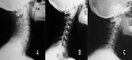 RECTIFICACION LORDOSIS CERVICAL – Blog de Fisioterapia
