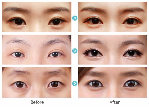 [Eye & Eyelid] Canthoplasty eyelid surgery for beautiful eyes