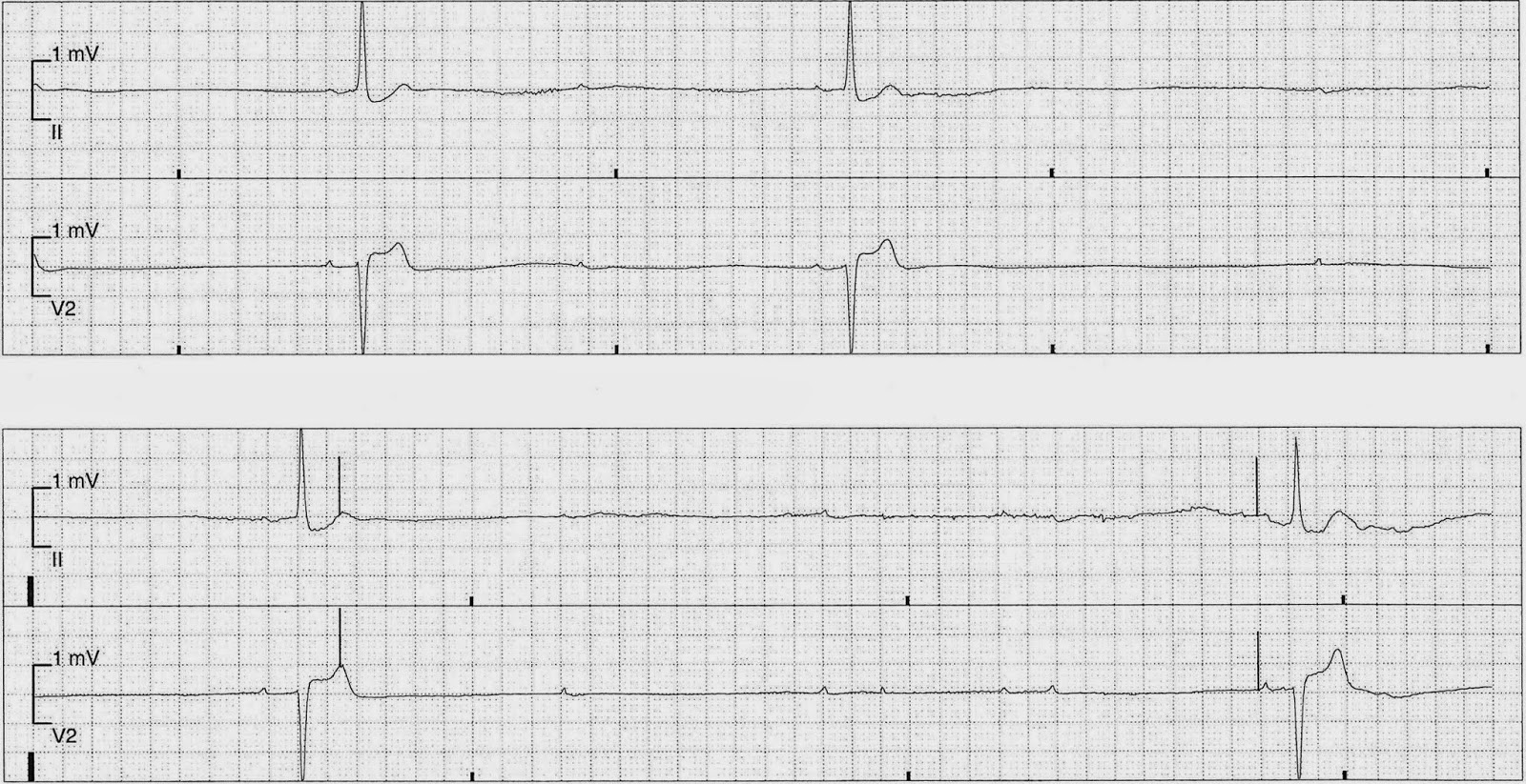 ECG of the Week: ECG of the Week - 15th December 2014 - Interpretation