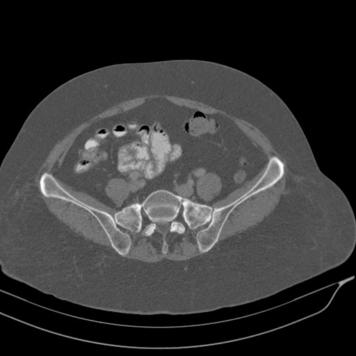 Ultimate Radiology : Castellvi Type IIIb LSTV