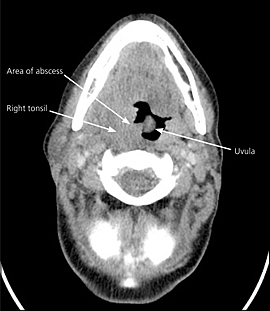 Tonsillitis Understood: Complications of Tonsillitis: Peritonsillar ...