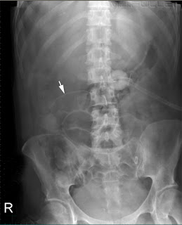 RIGLER'S SIGN | Imagining Imaging