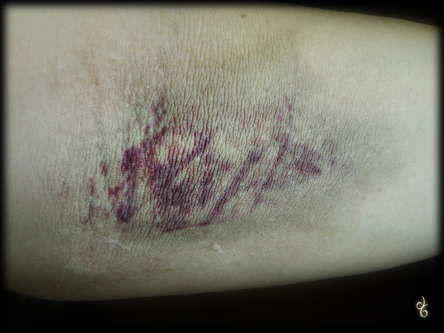 Deformutilation: Needle Bruises