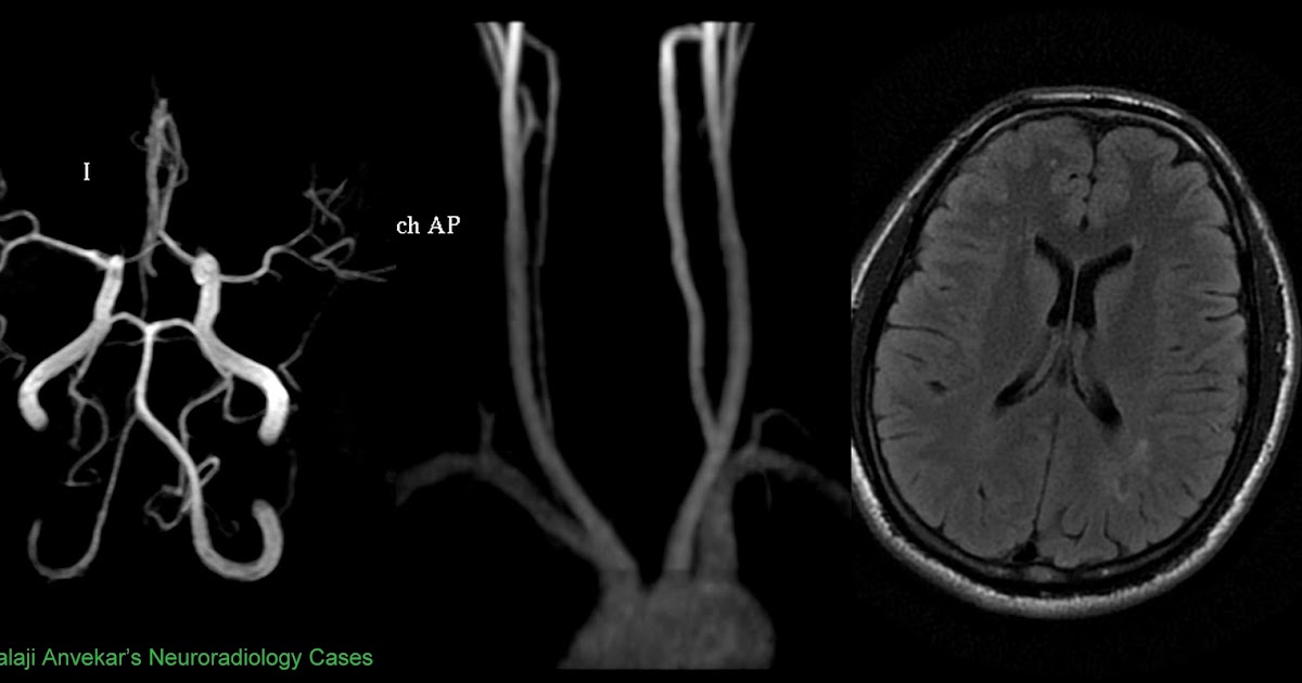 Dr Balaji Anvekar FRCR: Antiphospholipid Antibody Syndrome MR Angio Brain