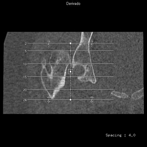 X-RAYview: Luxação da Anca