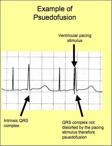 Cardiac Nurse: Teaching As I Learn: DDD pacing with psuedo fusion