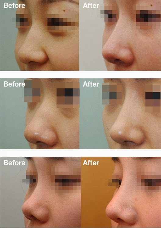 ID Hospital Korea: Advantage of Mini rhinoplasty