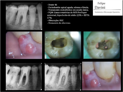 Davini - Endodontia e Microscopia Operatória: Tratamento endodôntico ...