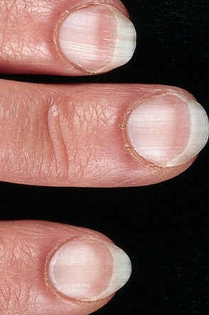 Health Info and Tips: Nail Can Describe Your Health