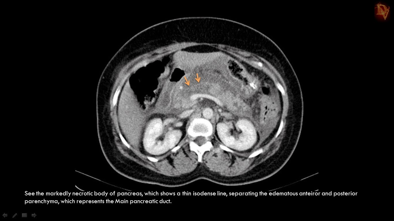 Ultimate Radiology : Acute Necrotizing Pancreatitis