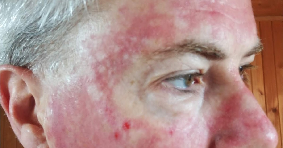 So let's see how this goes...Efudex/Efudix