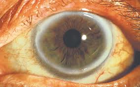 Auto diagnóstico de doenças: OLHOS - Sintoma: Anel à volta da cornea