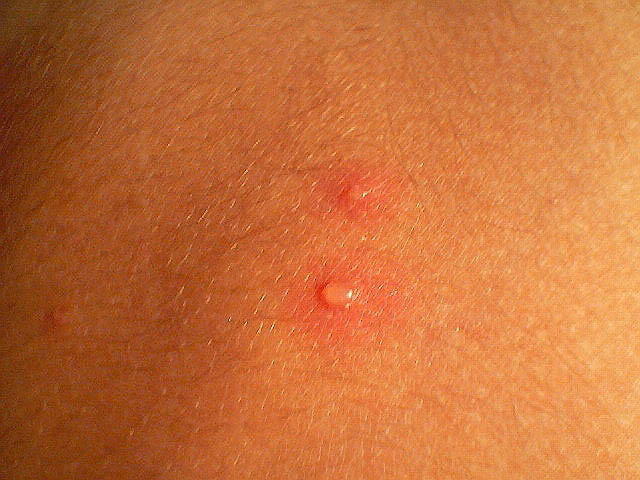 Varicela ~ Sanatate-Blog