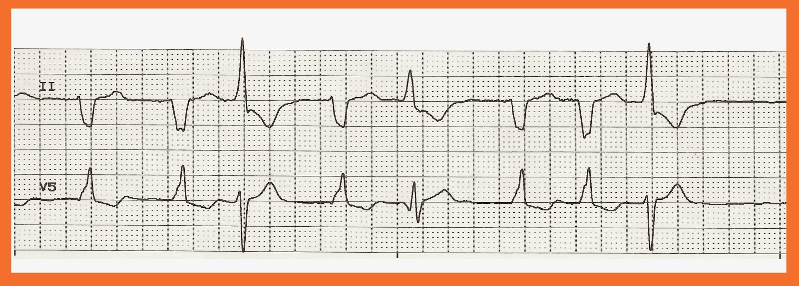 Practice Rhythm Strips 243
