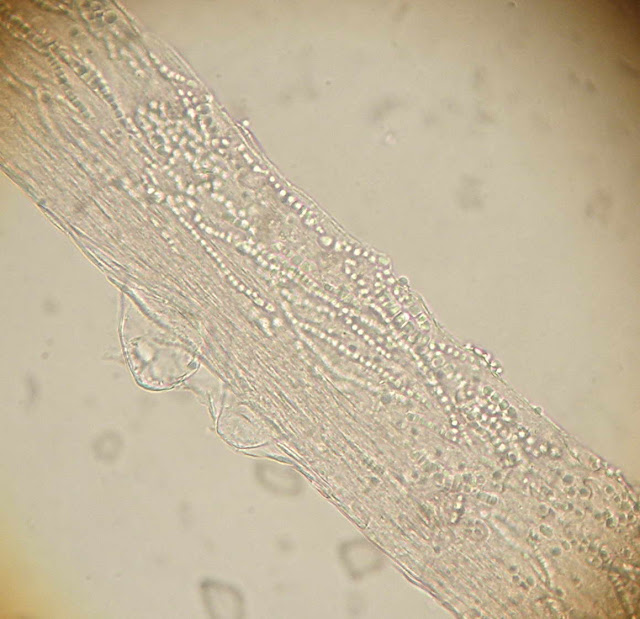 ATLAS MICOLOGIA: SICOSE POR TRICHOPHYTON MENTAGROPHYTES