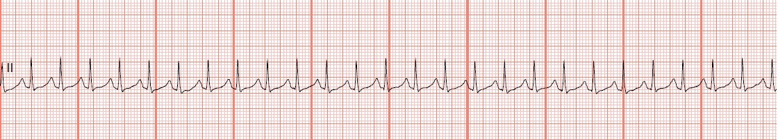 EKG Rhythm Strips 66