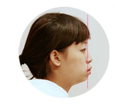 What is Faceline’s ASO (protruding mouth) Surgery?