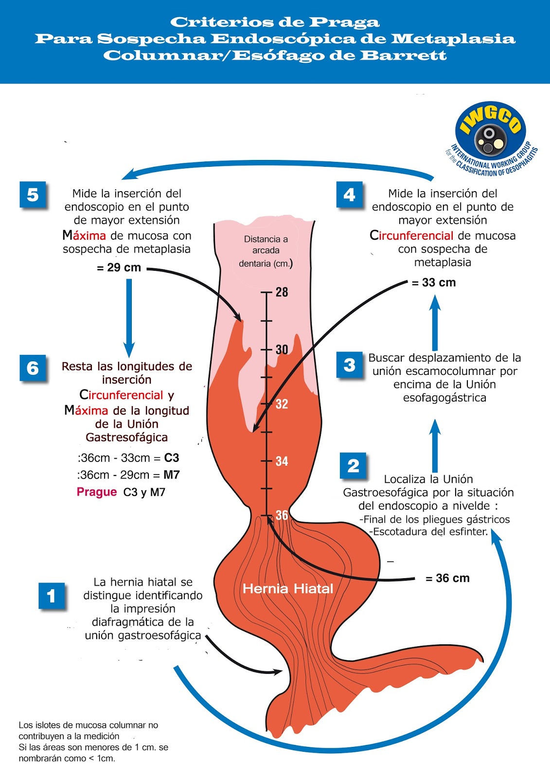 Doenças Raras Doem®: Esôfago de Barrett ou Síndrome de Barrett