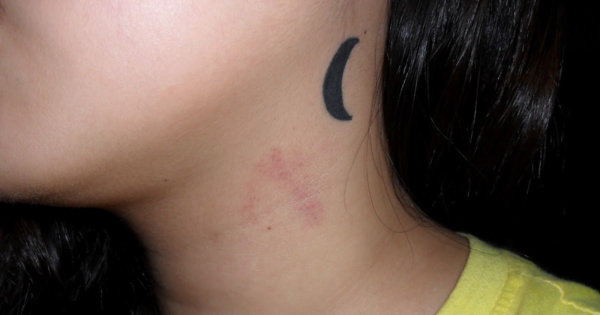 Everything will be okay: There's a hickey or a bruise