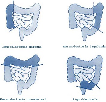 Cuidados de la colostomia: Cirugía degestiva.